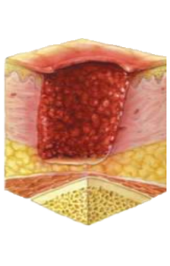 Trycksårskategorier - careofsweden